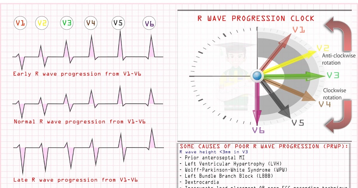 ECG Educator Blog : R-wave Progression
