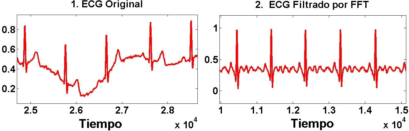 5 Minutos de Matlab: Código Matlab para acondicionar y filtrar señales de electrocardiogramas.
