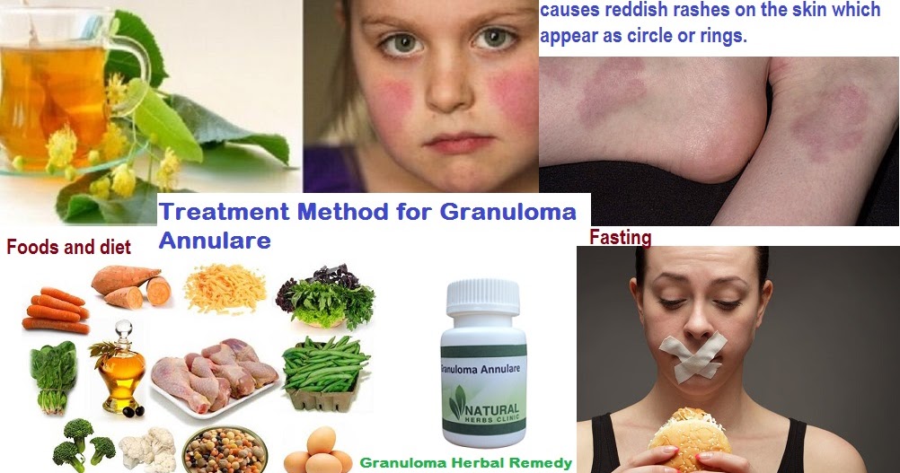 Granuloma Annulare Causes Diet