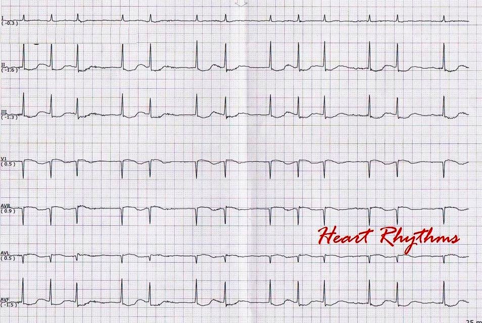 ECG Rhythms: Atrial fibrillation with entrance block and junctional ...