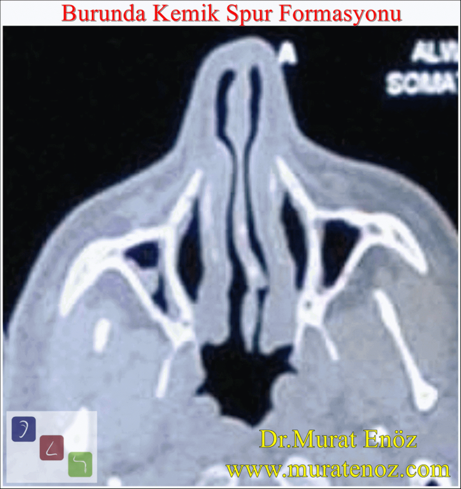 Top 98+ Pictures Bone Spur In Mouth Pictures Full HD, 2k, 4k