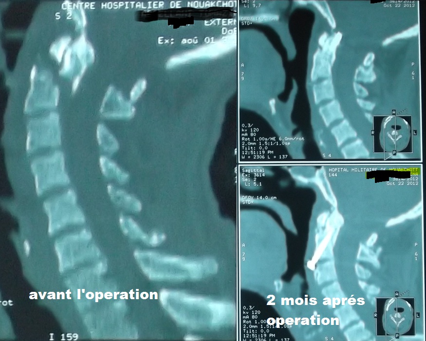 Docteur kleib LE BLOG : Une Fracture de L'ODONTOIDE operée à Nouakchott