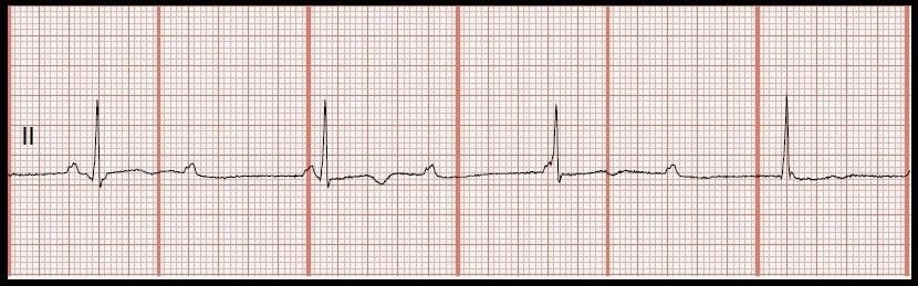 Various Third Degree Heart Blocks