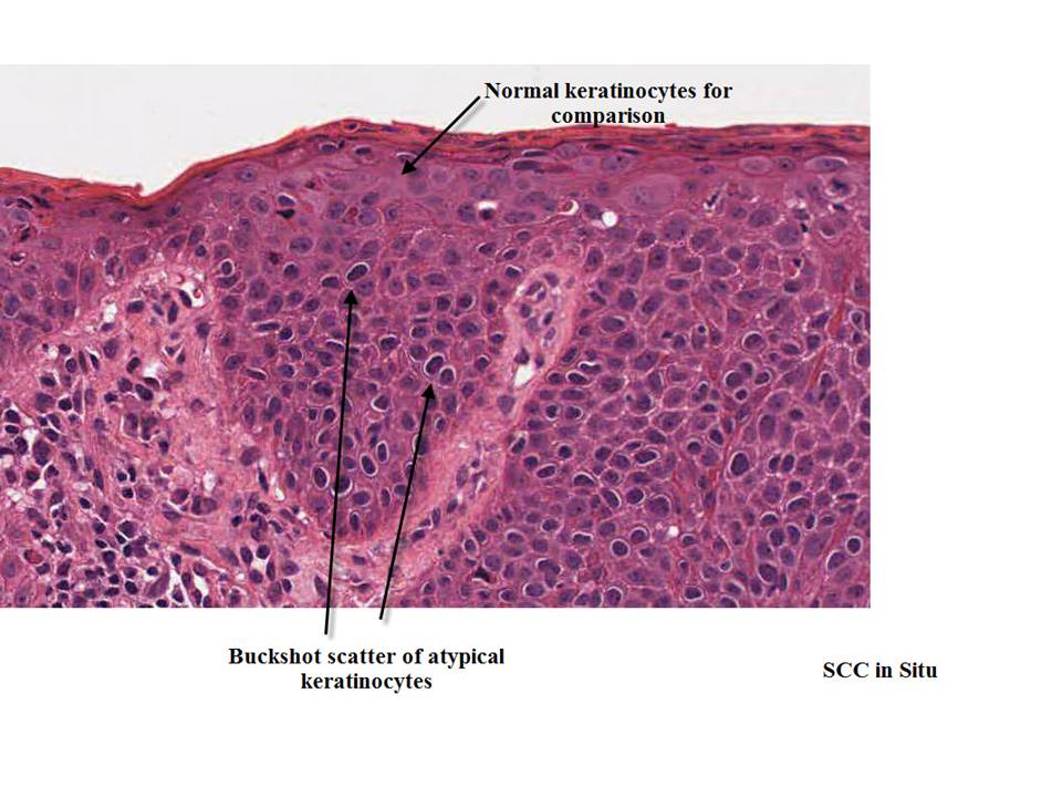 Dermpath Made Simple - Neoplastic: Squamous cell Carcinoma