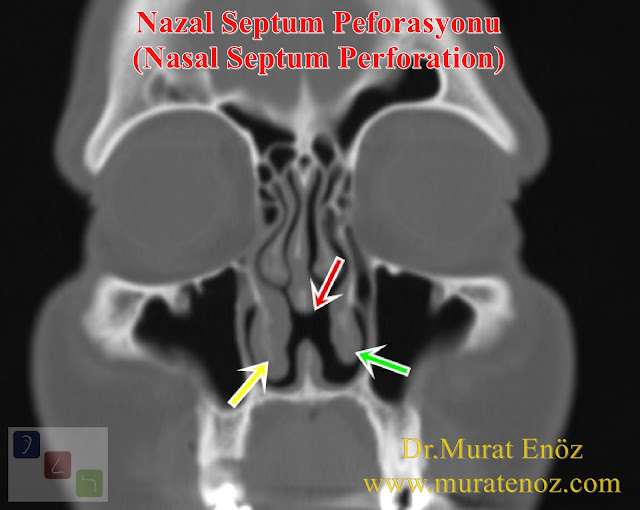 Nasal Septum Perforation - Definition, Causes, Symptoms, Diagnosis and ...