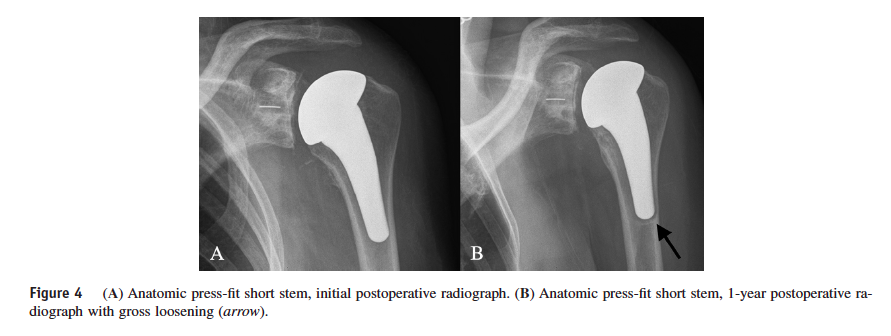Shoulder Arthritis / Rotator Cuff Tears / Shoulder Pain : Short humeral ...