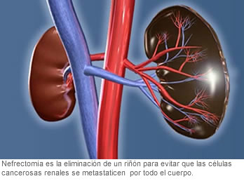 REVISTA AVANCES: NEFRECTOMIA POR LAPAROSCOPICA RETROPERITONEAL