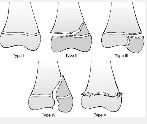 Distal Femoral Epiphysiolysis: Epifisiolisis Femur Distal