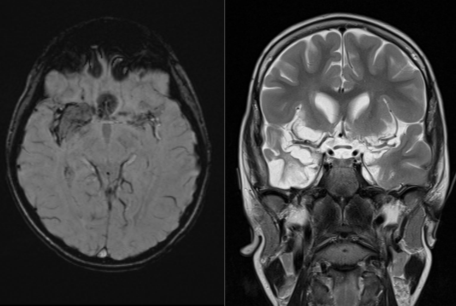 Herpes Simplex Encephalitis