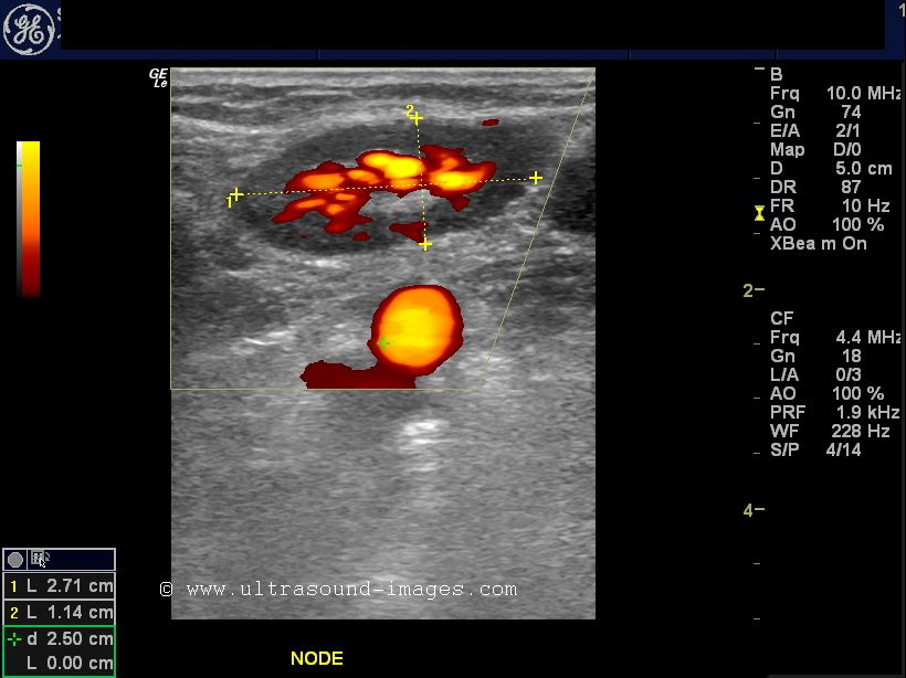 Normal and enlarged lymph nodes: ~ Ultrasound Cases Info