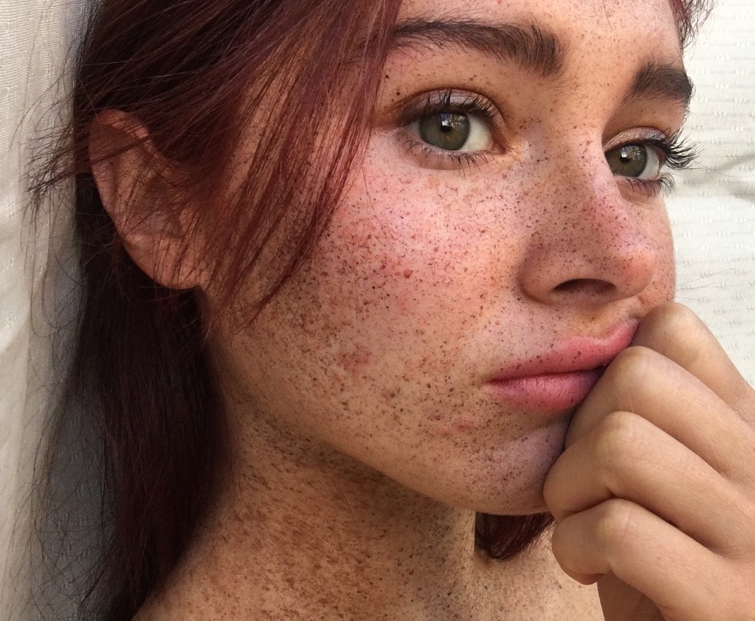 daily timewaster: Pensive freckles are good