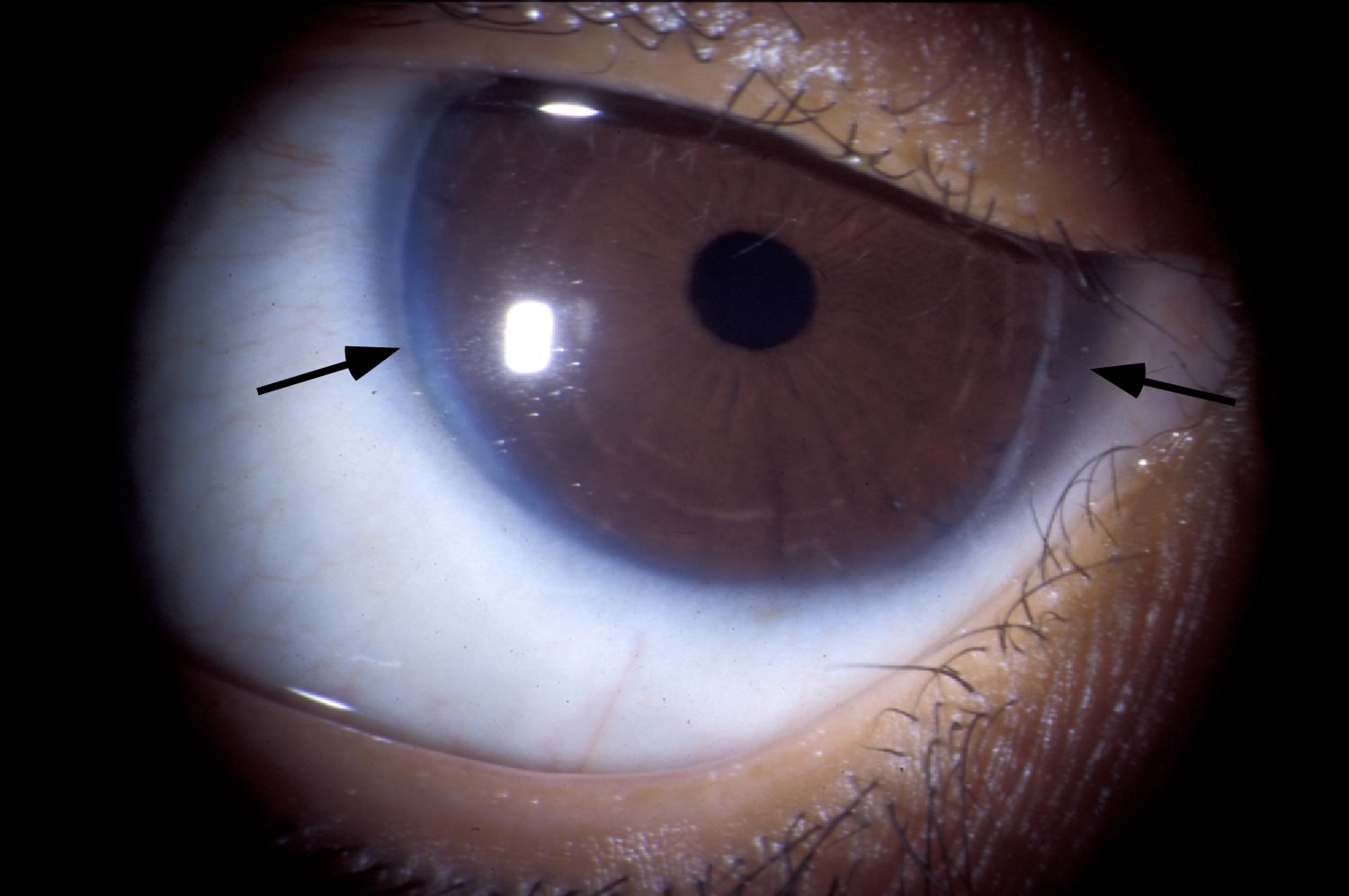 bryan's blog: My eye abnormalities - part 1