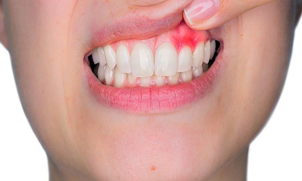 PERIODONCIA : Abscesos del periodonto. Conducta odontológica