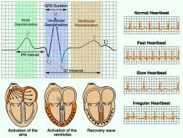 E Learning: ECG bij Syncope: WOBBLER - Acute Zorg Blog