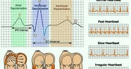 E Learning: ECG bij Syncope: WOBBLER - Acute Zorg Blog