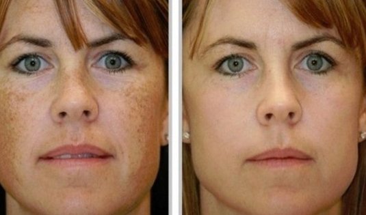 SE QUITÓ LAS MANCHAS MARRONES CON ESTE INGREDIENTE COMÚN. ¡ASOMBROSO ...