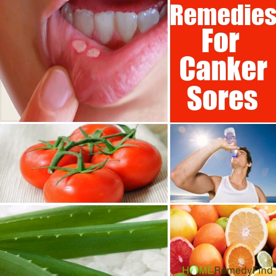 Home Remedies for Canker Sores - Home Remedies