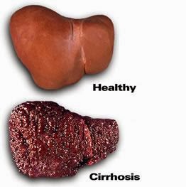 Penyebab Penyakit hati Perawatan dan Pencegahan | Tips Kesehatan ...