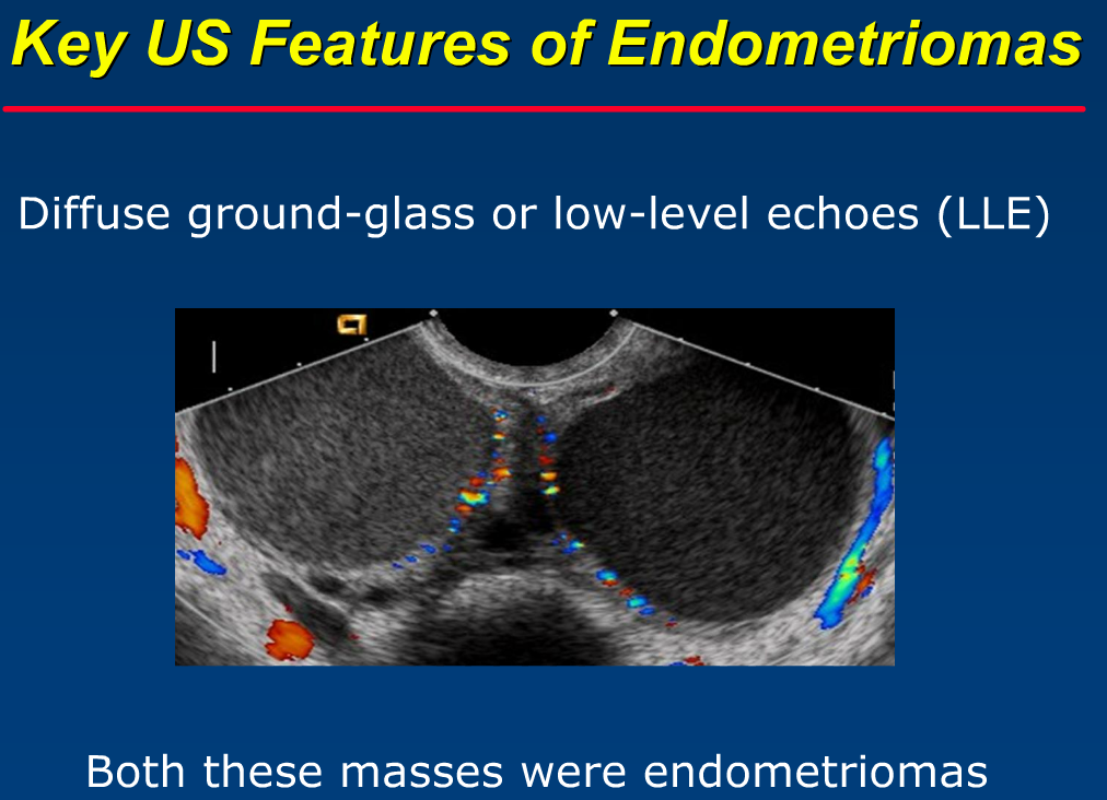 rsna: endometrioma