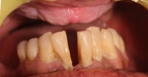 Basal dental implants cost: UPPER AND LOWER FULL ARCH RESTORATION WITH ...