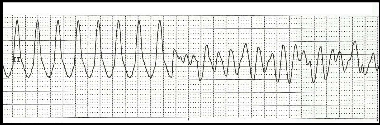Coarse Ventricular Fibrillation Rhythm Strip