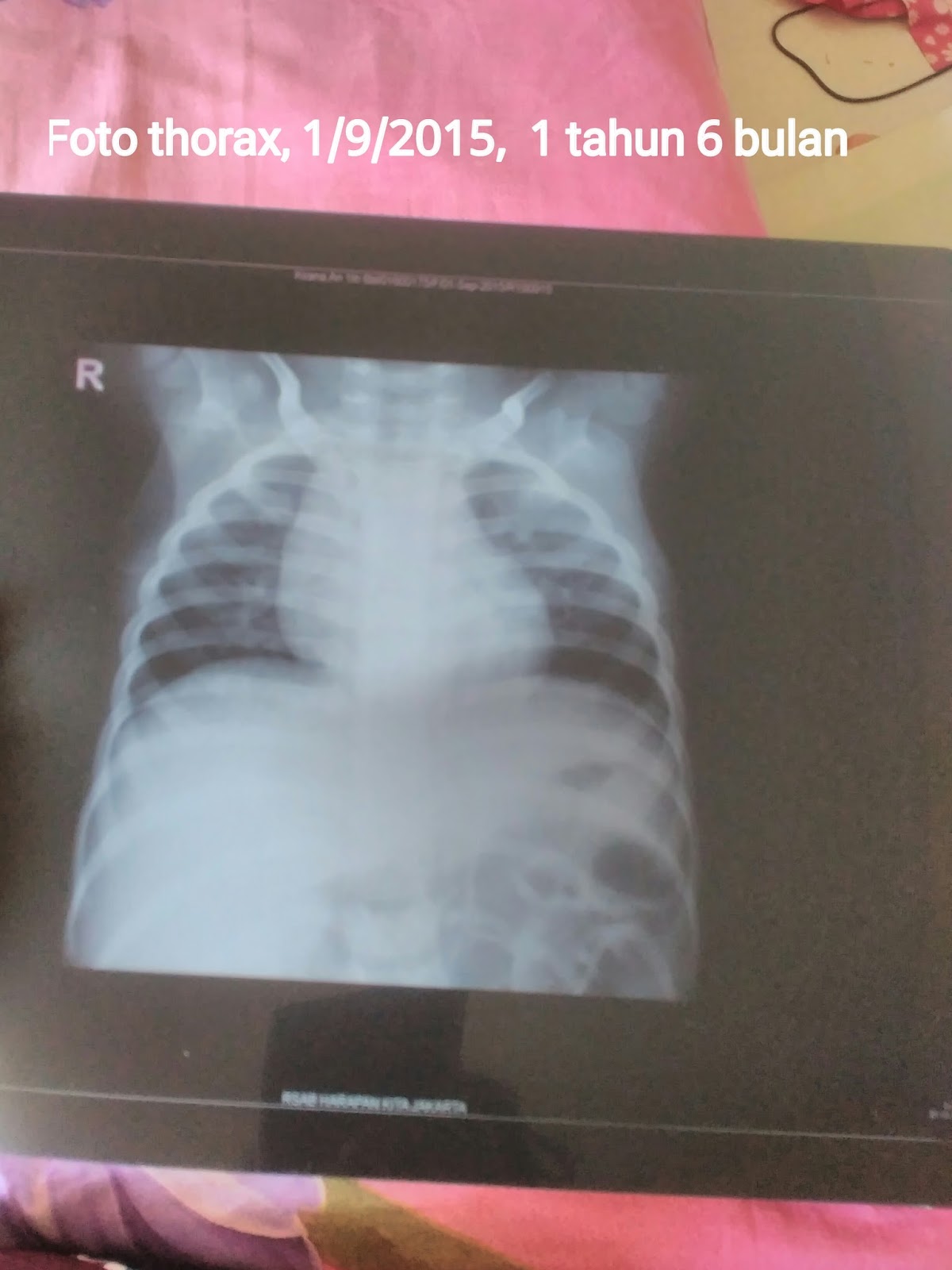 Mom2K's World: MESOCARDIA