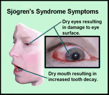 Sjogren's syndrome def., symptoms, signs, investigations, treatment ...