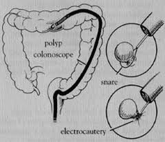 COCHIN CARDIAC CLUB: POLYPS OF COLON