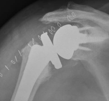 UW Shoulder and Elbow Academy: Failings of a reverse total shoulder