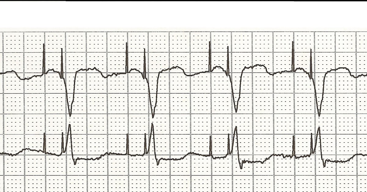 EKG Rhythm Strip Quiz 14