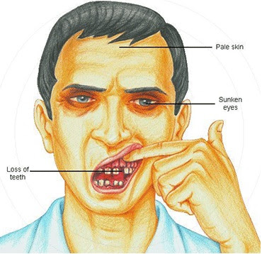 Sailors and Scurvy Disease ~ PINOY SEAMAN PH