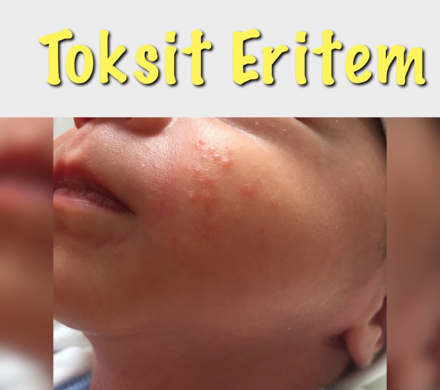 Toksik Eritem