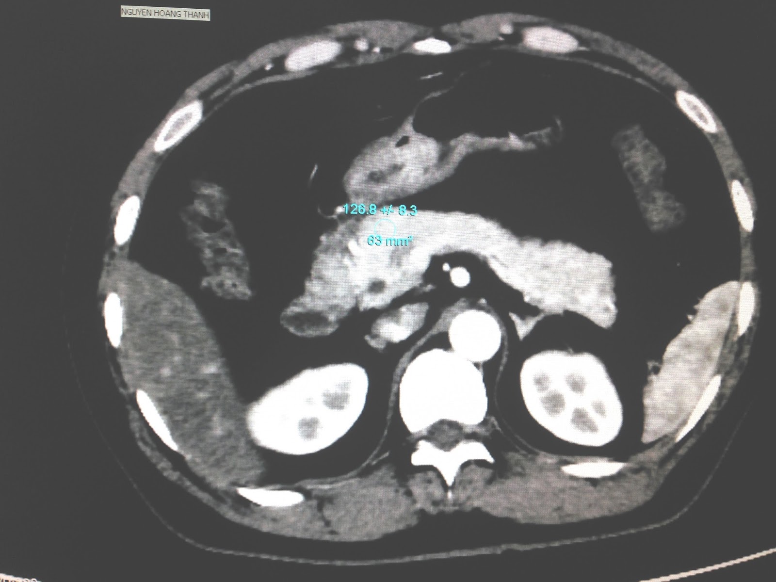 VIETNAMESE MEDIC ULTRASOUND: CASE 379: ECTOPIC PANCREAS TISSUE in ...