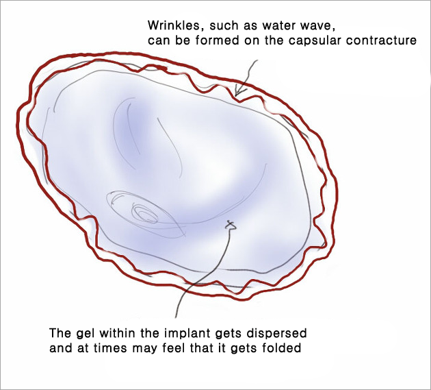 Dr. Lee Breast augmentation Korea: What to do when suffering from ...