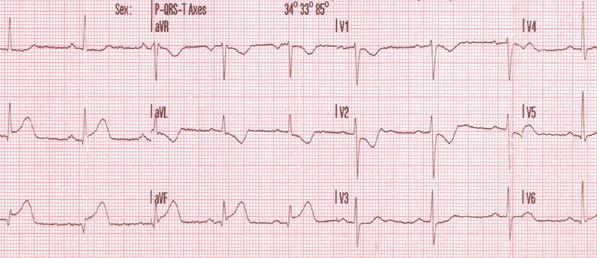ECGs for EMS: Identification and localization of STEMI: POSTERIOR WALL