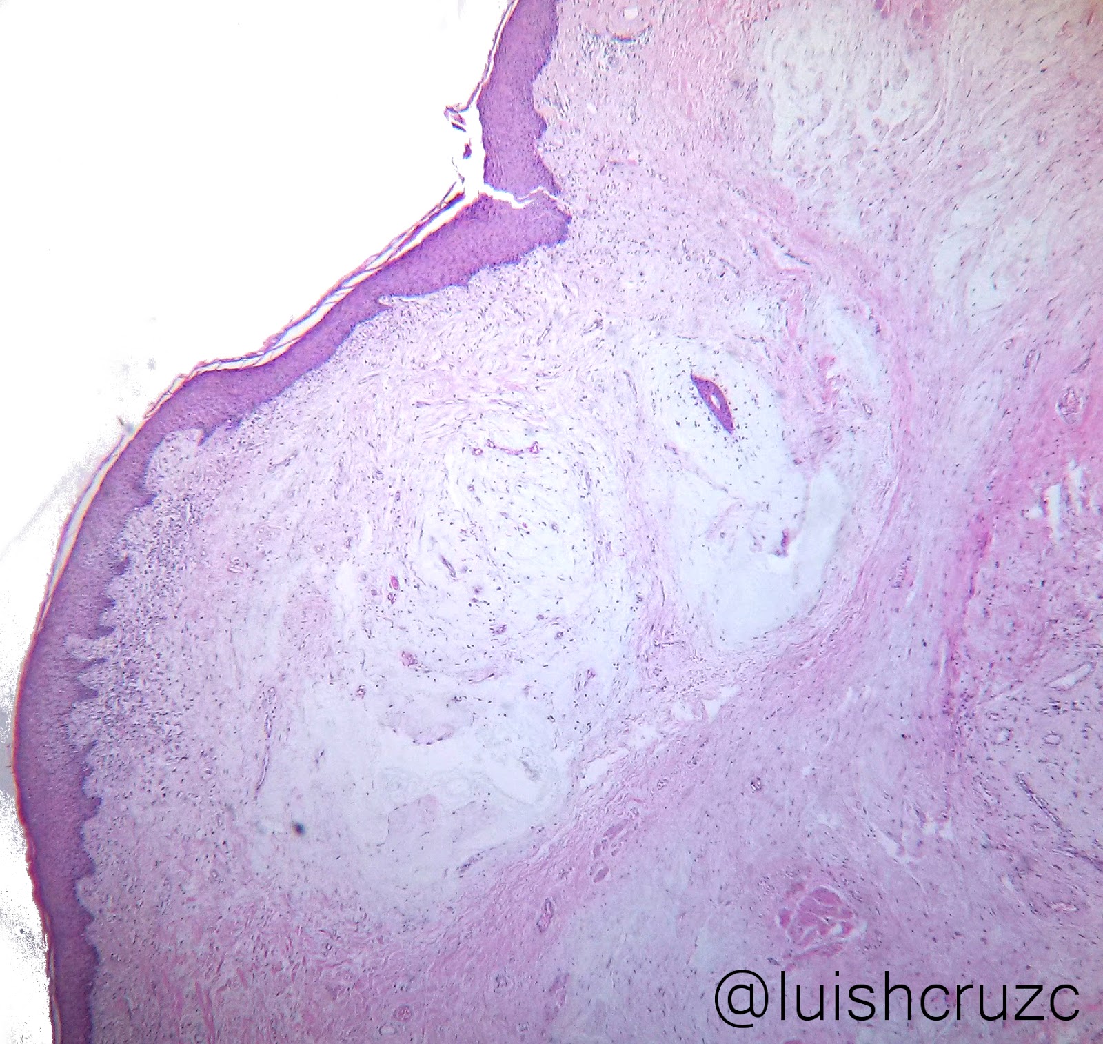 Patología CC: Angiomixoma profundo (agresivo)