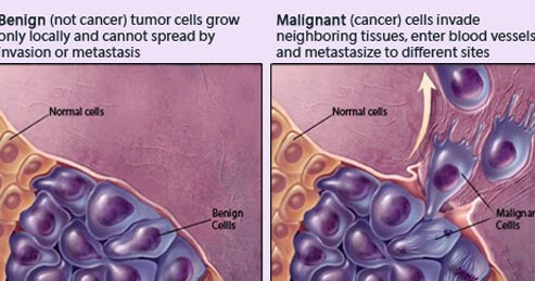 Healthy Life: Understanding Cancer
