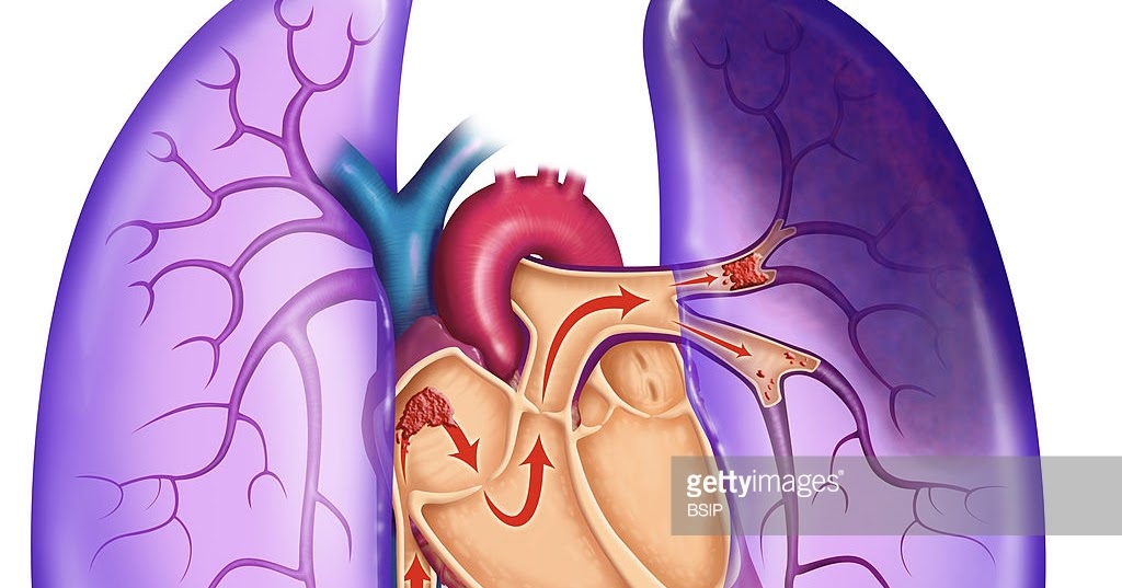 Acute Pulmonary Embolism | INA - ECG