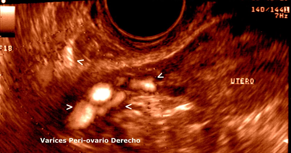Varices Pelvicas