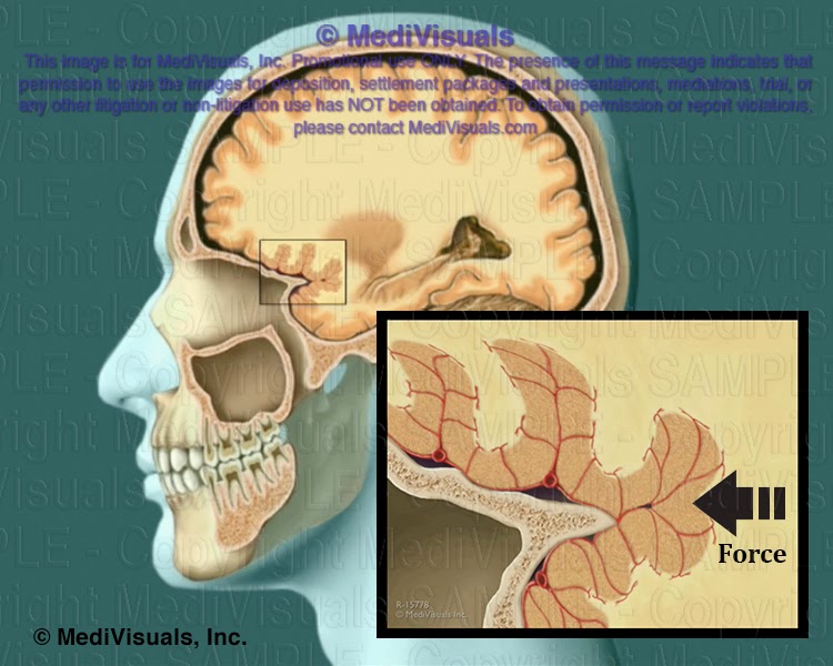 The Medical Legal Exhibit Expert Blog: Understanding Traumatic Brain ...