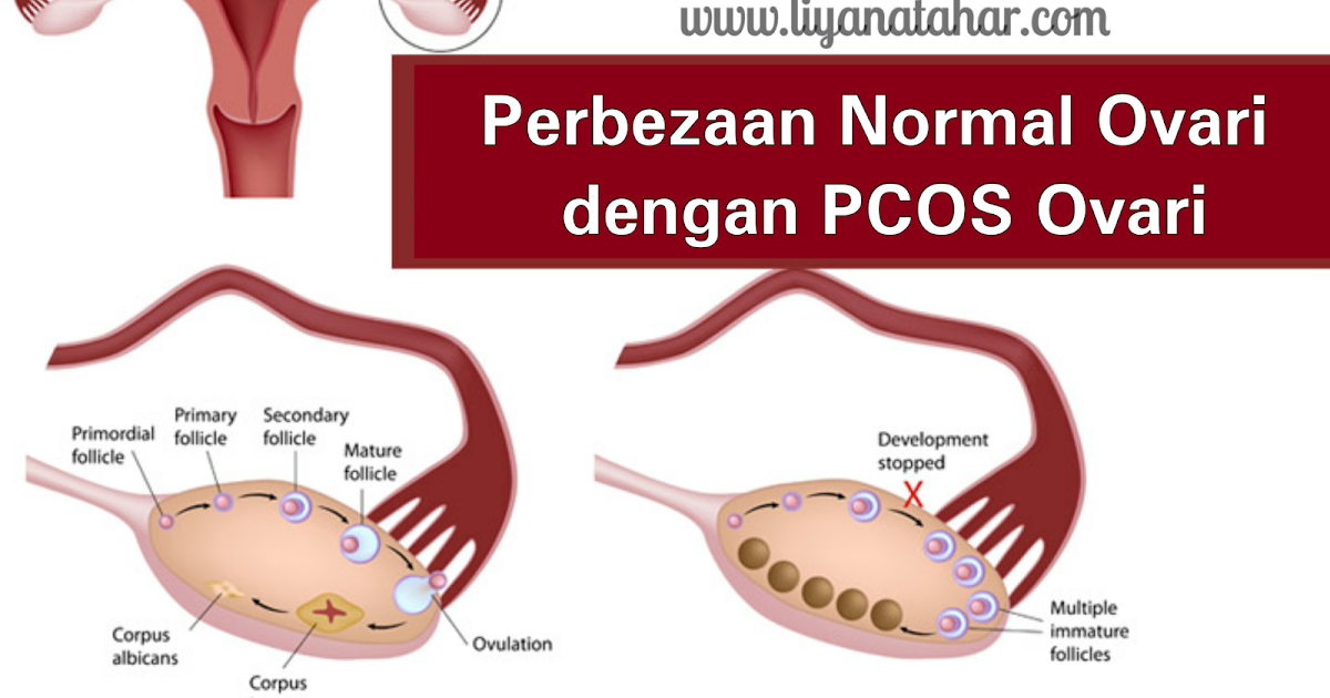 Apa Itu Penyakit Pcos - Perumperindo.co.id
