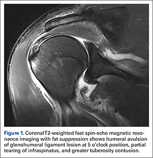 MRI Musculo-Skeletal Section: HAGL and GAGL lesions.