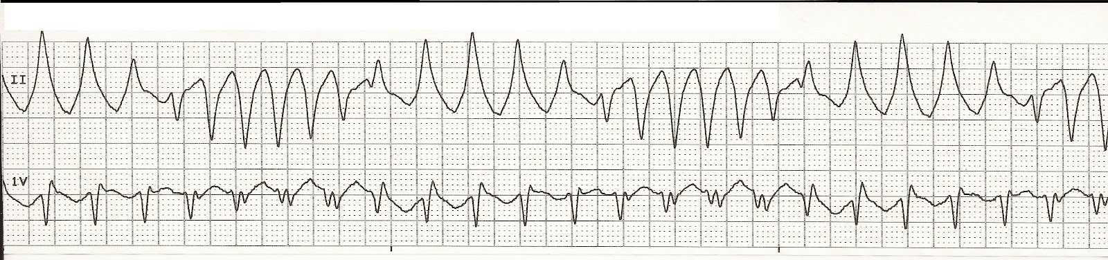 EKG Rhythm Strip Quiz 8