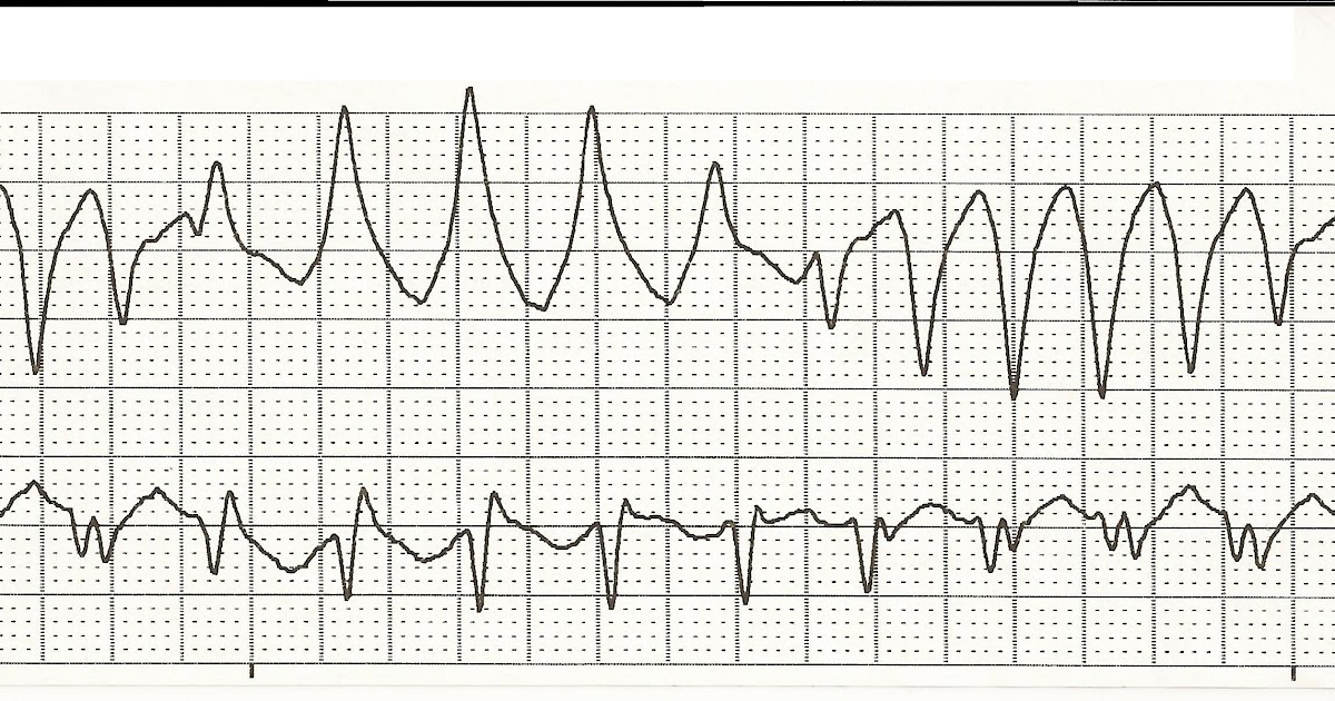 ACLS review: Wide Complex Tachycardia (WCT) Part 9