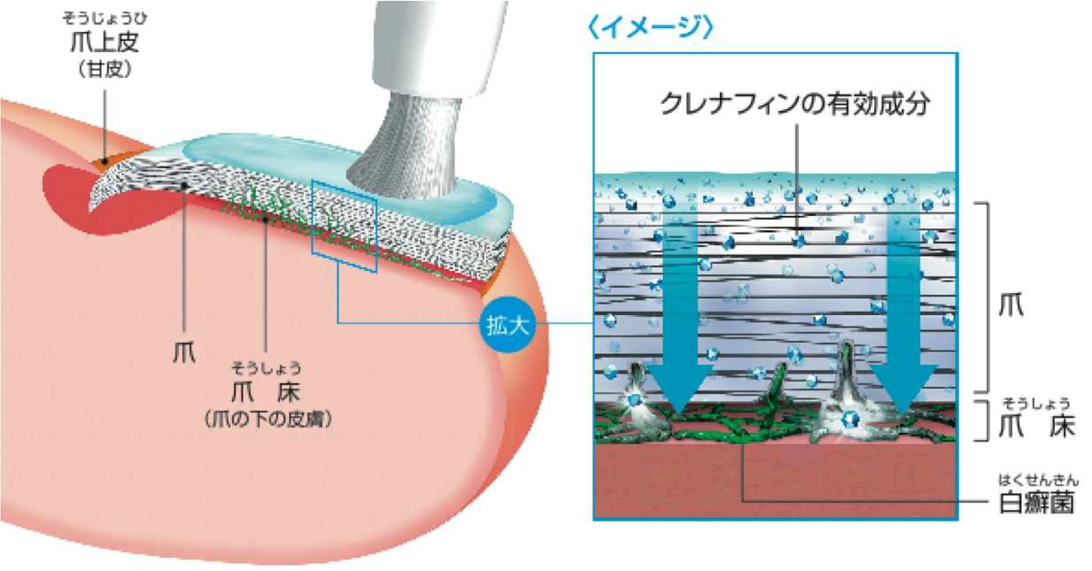 爪水虫を塗り薬クレナフィンだけで完治させる！: 本気で爪水虫（爪白癬）を治そうと病院に行くまで