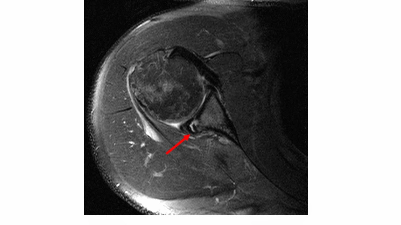 Shoulder and Elbow Surgery: Reverse Bankart lesions and shoulder ...