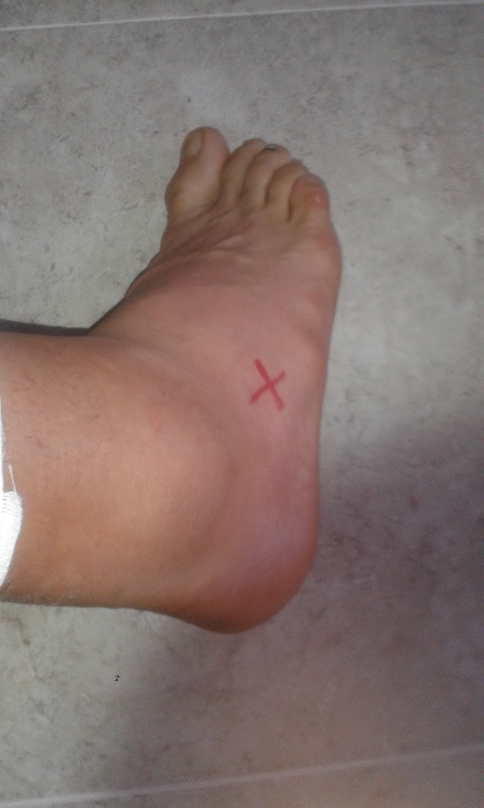 AC77: Tendinitis de peroneos e inflamación traumatica de soleo ...