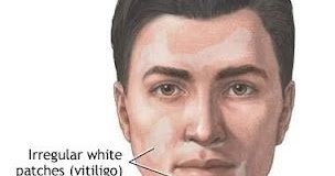 How Vitiligo Affects An Individual Life?: Symptoms and Causes of Leucoderma