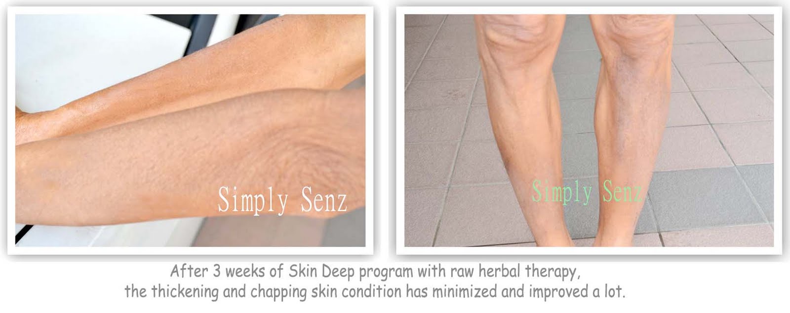 Simply Senz: Skin Deep Herbal Healing Therapy