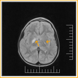 Neurofibromatosis-I - Sumer's Radiology Blog